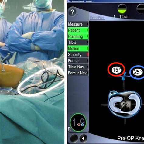 Intraoperative Images Showing The Use Of Navigation System Download Scientific Diagram