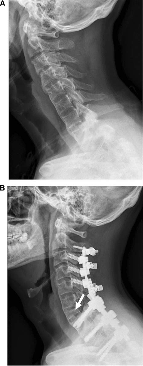Lateral Preoperative A Radiograph Demonstrating Fixed Sagittal