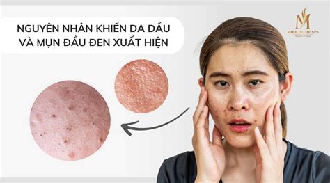 Nguyên Nhân Khiến Da Dầu Và Xuất Hiện Mụn đầu đen Mire Home Spa Master Of Skin