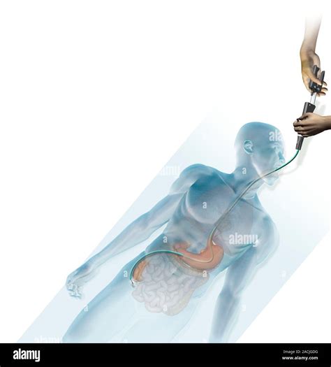 Laparoscopic Appendicectomy Computer Artwork Showing A Persons Appendix Being Removed Using