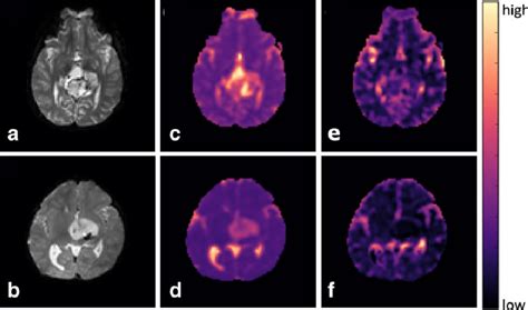 Example Cases Of Glioneuronal Tumor Top And Hypothalamic Glioma