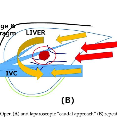 Open A And Laparoscopic Caudal Approach B Repeat Liver Resections Download Scientific