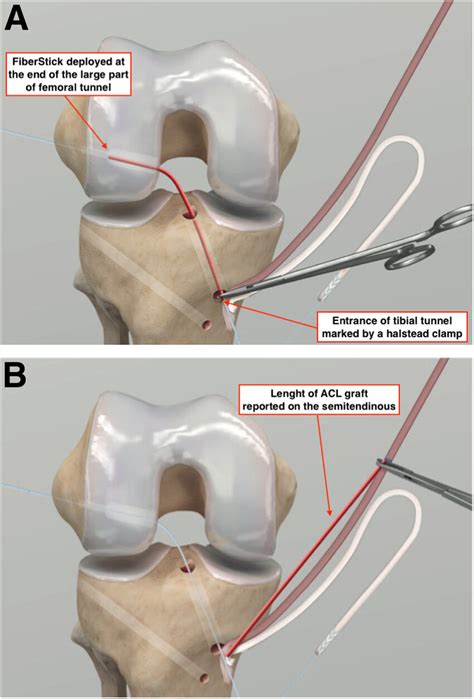 Measurement Of The Anterior Cruciate Ligament Acl Graft Using The Download Scientific Diagram