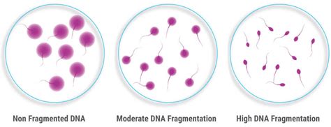 Sperm Dna Fragmentation Test In Hyderabad Sperm Test For Male