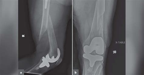 Femur Fracture