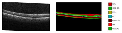 A Novel Intraretinal Layer Semantic Segmentation Method Of Fundus Oct Images Based On The
