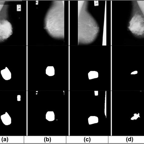 Automated Mammogram Breast Cancer Detection Using The Optimized Combination Of Convolutional And
