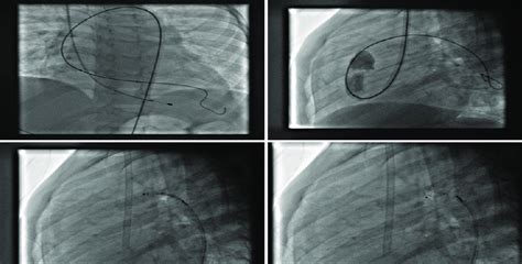 Temporary Pacemakerbpv And Pda Device Via Rijv Route Download