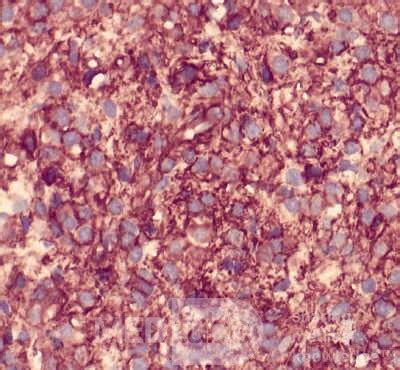 Gastrointestinal Stromal Tumor GIST Of Image MEDtube Net