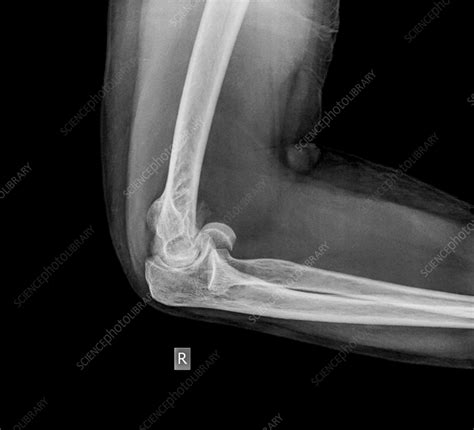 Fractured Elbow X Ray Stock Image C056 4057 Science Photo Library