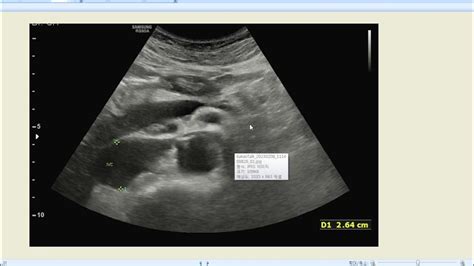 1췌장 실질 지방 침윤 2 췌장 두부 배측 지방 회피구역 3 췌장 구부 낭종 56세 남성 Youtube