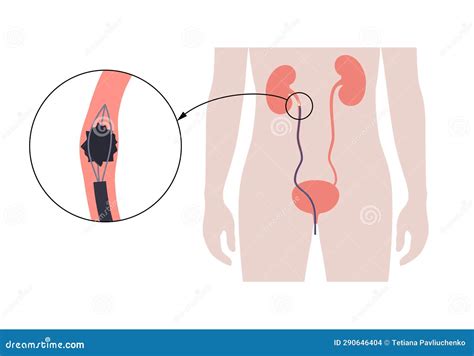 Ureteroscopy Medical Poster Stock Vector Illustration Of Specimen Stone 290646404