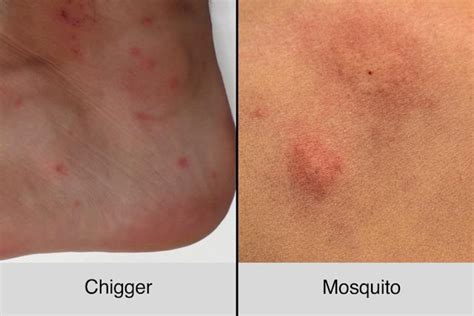 Chigger Bug Bites First Aid Treatment For Chiggers Hsi