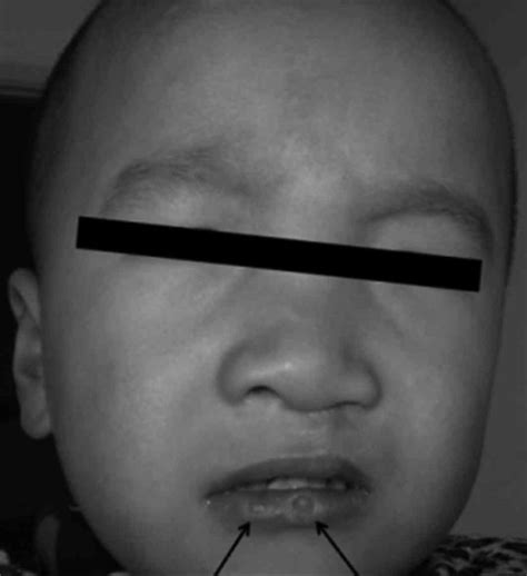 Percent Of Van Woude Syndrome