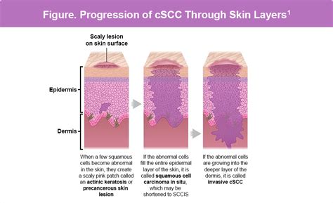 Advanced Cscc Catalyst Regeneron