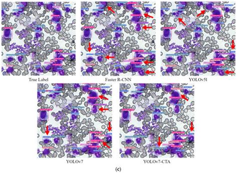 Improved Yolov7 Algorithm For Detecting Bone Marrow Cells