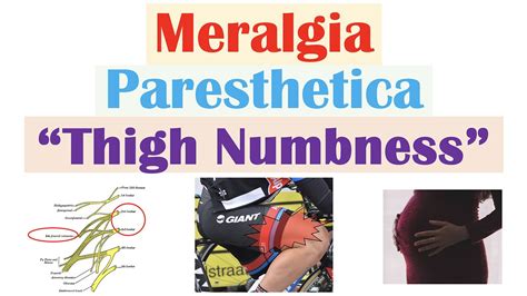 Meralgia Paresthetica “numbness Of The Thigh” Causes Symptoms