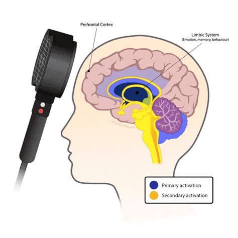 TMS Therapy In Los Angeles At Mindful Health Solutions