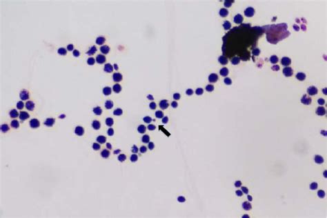 Figure 1 From First Description Of Oral Cryptococcus Neoformans Causing