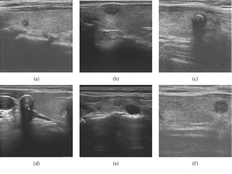 Figure 1 From Thyroid Nodule Classification In Ultrasound Images By Fusion Of Conventional