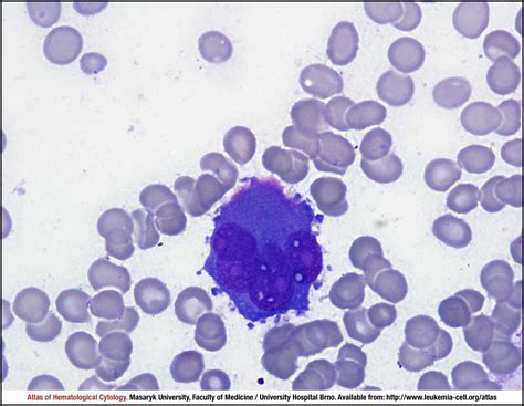 Plasma Cell Myeloma Cell Atlas Of Haematological Cytology