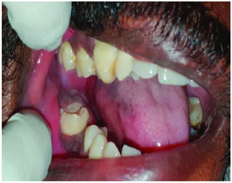 Intra Oral Photograph Revealing A Diffuse Swelling In Relation To 47