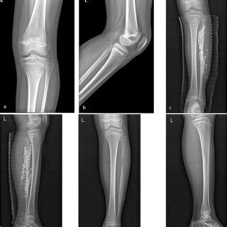 A B A Seven Year Old Girl Suffered Left Distal Tibial HO C D Download Scientific Diagram