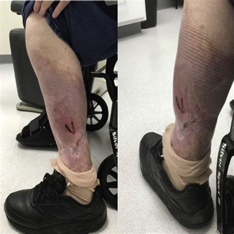 Severe Pyoderma Gangrenosum Involving The Left Lower Extremity With