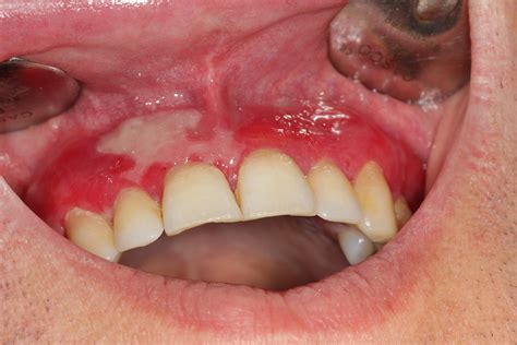 Mucous Membrane Pemphigoid Mild