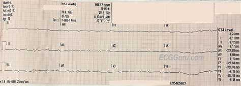Instructors Collection Ecg Ventricular Standstill Ecg Guru