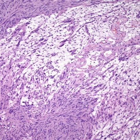 Soft Tissue Classifier Classification Model By Soft Tissue Lesions