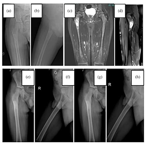 Giant Cell Tumor In The Proximal Tibia A And B Preoperative Graph Download Scientific