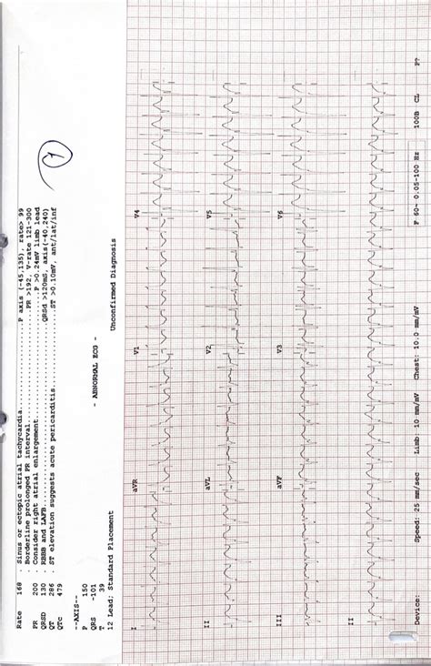 Dr Ashutosh Kumar On Linkedin Fascicular Adenosine Elctrophysiolgist Curable 3d Arrhythmia…