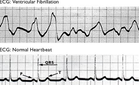 Pulseless Arrest MOST IMPORTANT Flashcards Quizlet