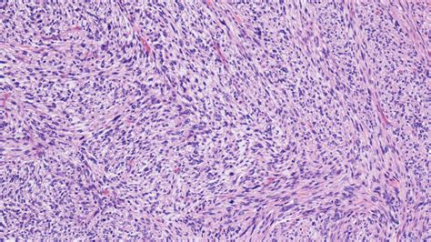 Leiomyosarcoma Atlas Of Pathology