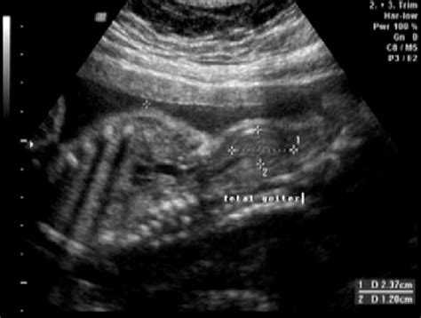 2d Ultrasound Image Of Fetal Goiter Fig 2 Doppler Ultrasound Image Download Scientific