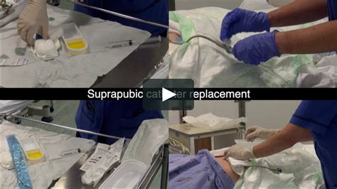 Suprapubic Catheter Replacement On Vimeo