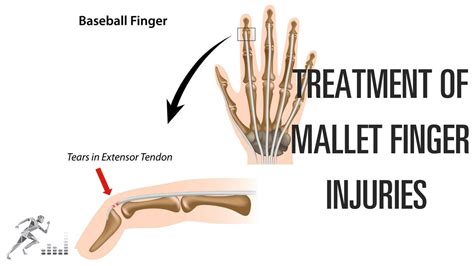 How To Fix Mallet Finger Mallet Finger Exercises For Recovery Emxvrb