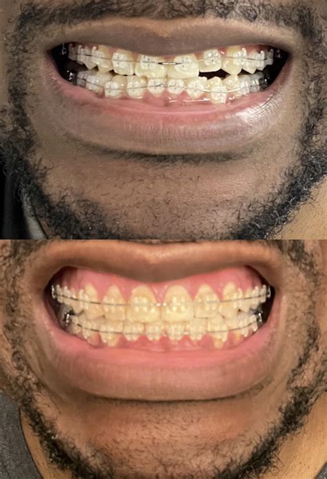Three Months Progress R Braces