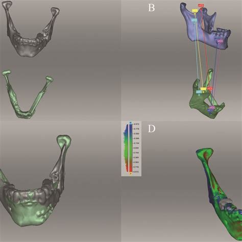 Three Dimensional Surface Matching Procedure Of The Corresponding Pre