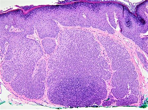 Pathology Outlines Poroma