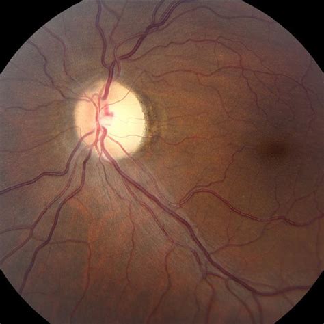 Left Optic Disc Pallor Download Scientific Diagram