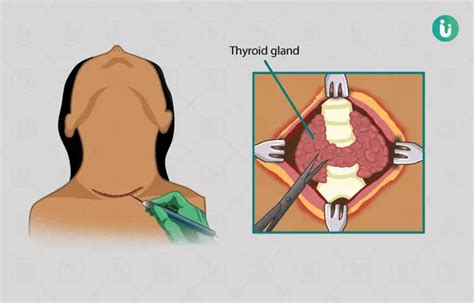 Thyroid Nodule Surgery Recovery Time Thyroidectomy For Thyroid Cancer