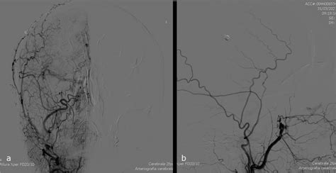 Six Months Follow Up Dsa Ap And Ll Views Showing Complete Occlusion