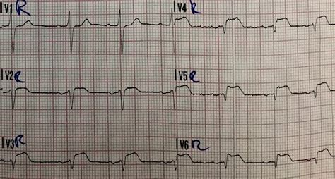 Acute Inferior Stemi With Right Ventricular Infarction And Cardiac Arrest Acls Medical Training