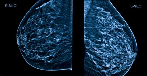 Artificial Intelligence Ai Computer Aided Detection Cad Shows Promise For Breast Cancer