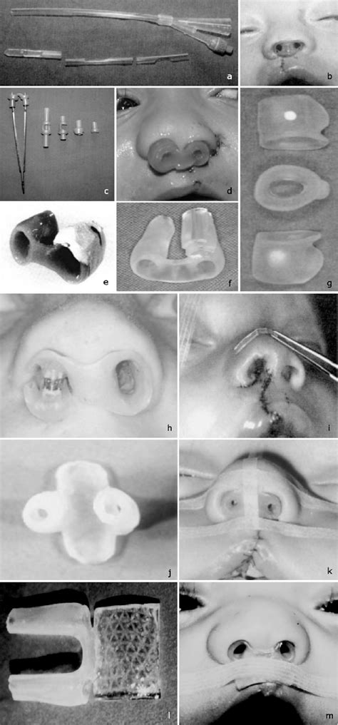 Overview Of Different Splint Types Available In The Literature A B Download Scientific