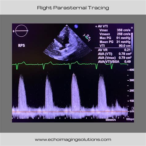 Aortic Stenosis The Perfect Tte By Aram K