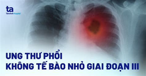 Kỹ Thuật Chụp X Quang K Phổi Giai đoạn 3 Hiện đại để Phát Hiện Sớm Bệnh