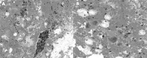 A Moderate To Markedly Atypical Spindle Cells B Plump Looking